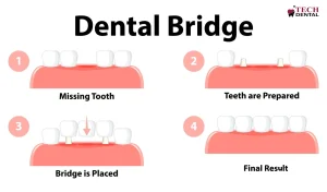 Dental Bridge 2026: Ultimate Cost, Types, Safe Procedure A-Z