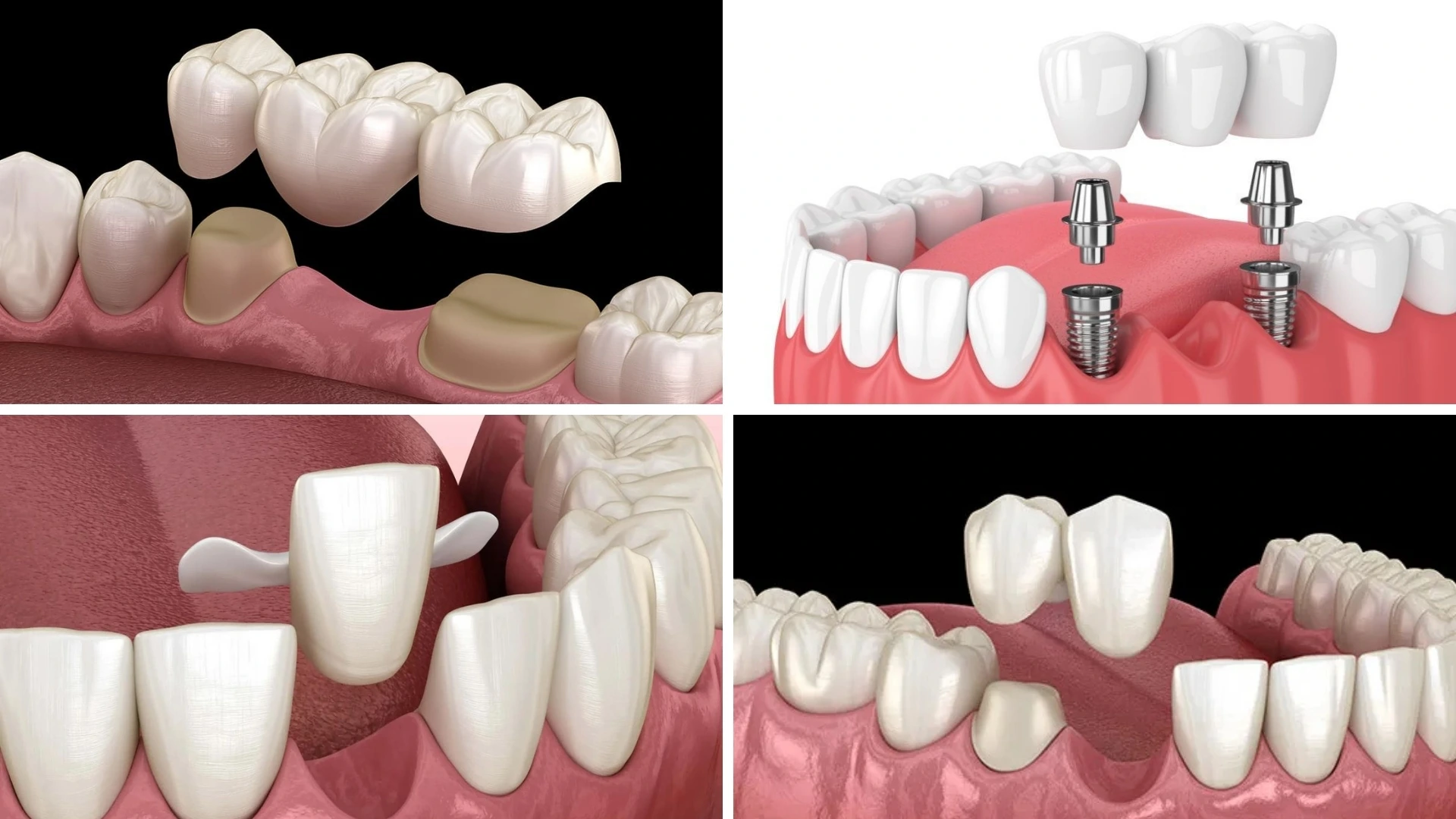 Dental Bridge 2026: Ultimate Cost, Types, Safe Procedure A-Z